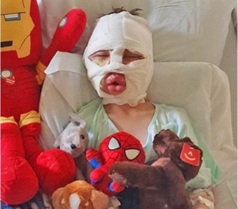 Un niño, quemado con una pelota de tenis en llamas